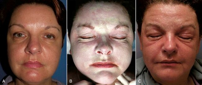 Peeling de ATA: Ácido Tricloroacético - Marcio Guidoni