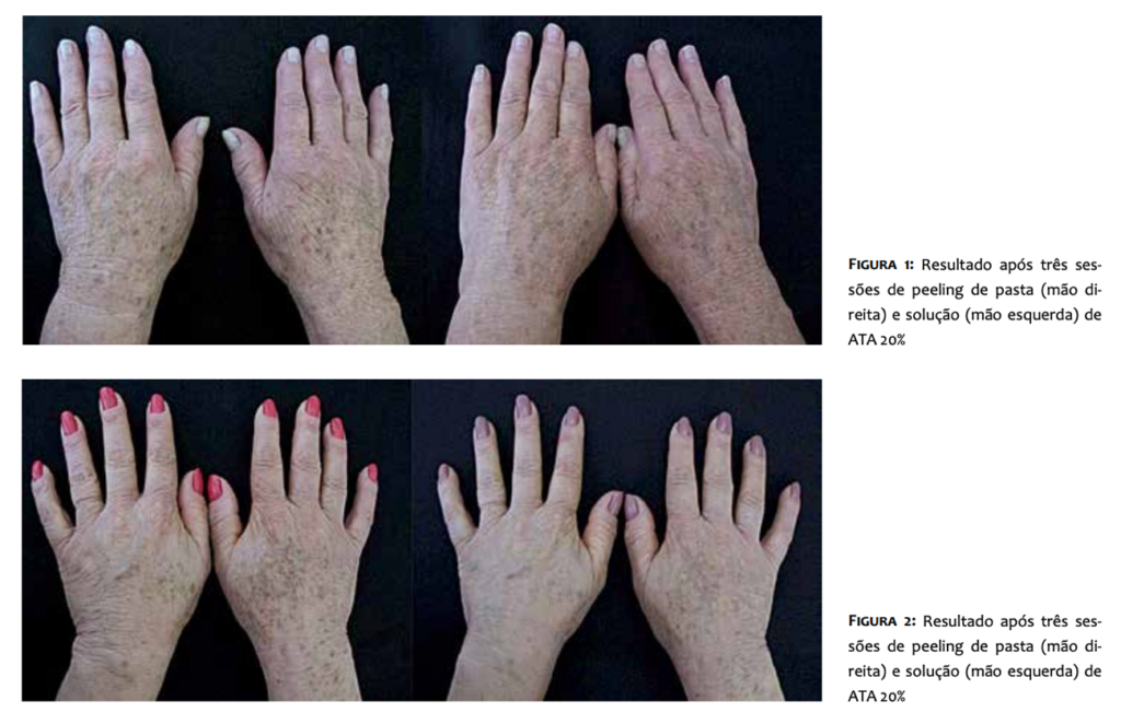 Peeling de ATA: Ácido Tricloroacético - Marcio Guidoni